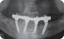 Cirurgia e Traumatologia BucoMaxiloFacial: Qual é a melhor configuração ...